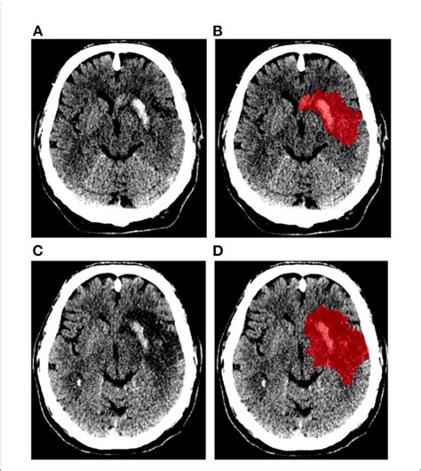 Figure Example Of Ischemic Lesion Segmentation Represented In Red