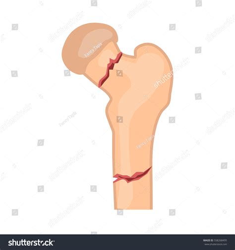 Hip Fracture Icon Osteoporosis Bone Vector Stock Vector Royalty Free