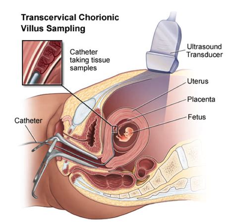 Chorionic Villous Sampling Cvs What To Expect