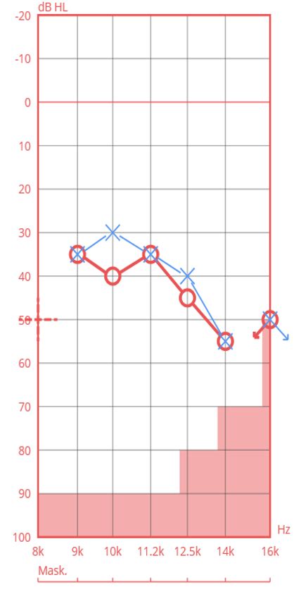 When Is Ultra High Frequency Audiometry Clinically Useful Ask The