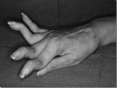 Swan Neck Deformity