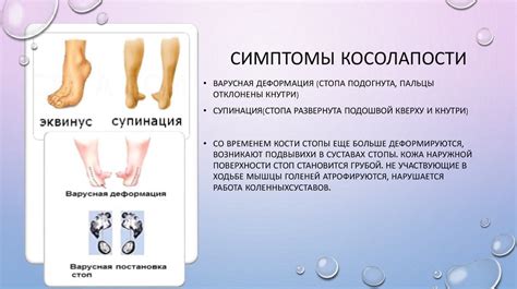 Пороки развития нижних конечностей презентация онлайн
