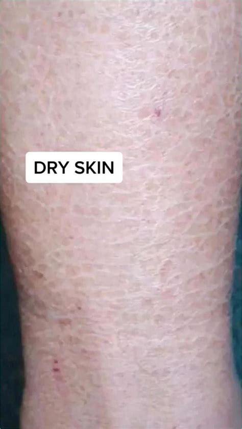 Seborrheic Keratoses Signs And Symptoms Artofit