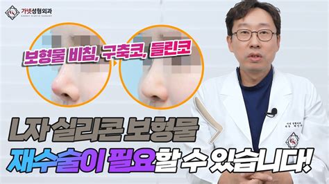원장님 코성형 보형물이 코를 뚫고 나올것 같아요😭 보형물 비침 구축코 들린코 L자실리콘 코재수술 방법 알려드립니다