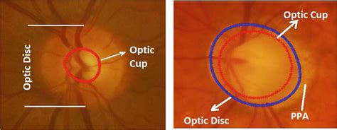 Comparison Of The Optic Disc Area Of The A Normal And B Glaucomatous Download Scientific