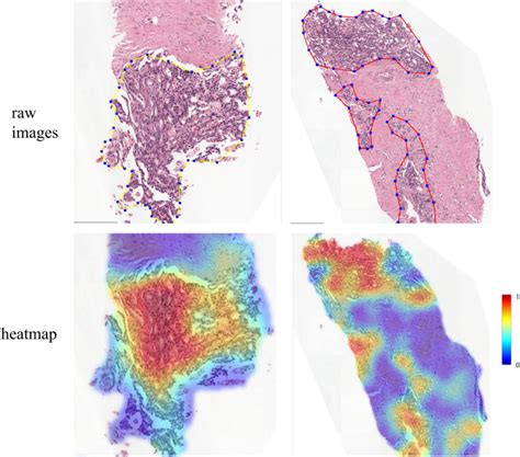Federated Learning With Hyper Networka Case Study On Whole Slide Image Analysis Pmc