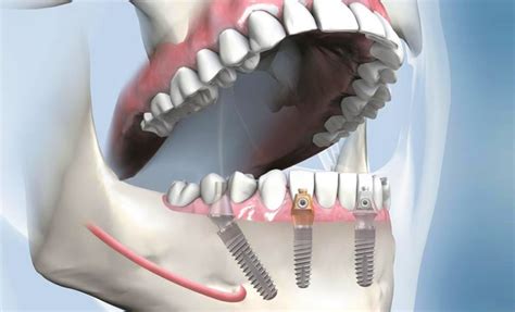 Dinti Ficsi In 24 Ore Implant Dentar Rapid O Dantura Fixa Intr O Zi