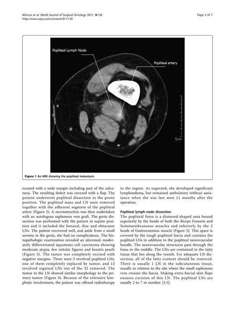Solution Popliteal Lymph Node Dissection For Metastatic Squamous Cell