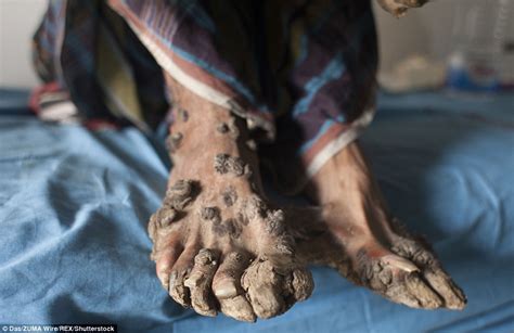 Bangladeshi Babe Suffers With A Rare Skin Condition That Makes Warts Look Like Roots Daily Mail