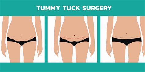 Tummy Tuck Abdominoplasty What Types Steps And Potential Complications