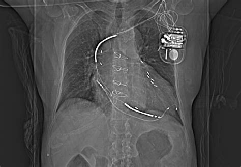 Pacemaker Electrode Placement Radiology At Beau Eardley Wilmot Blog