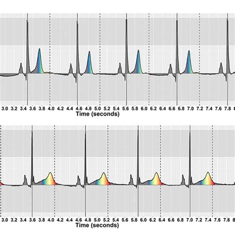 Pseudo Coloured Ecgs That Have Different Heart Rates But Similar Download Scientific Diagram