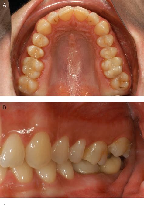 Figure 5 From Maxillary Molar Intrusion Using Mini Implants In The