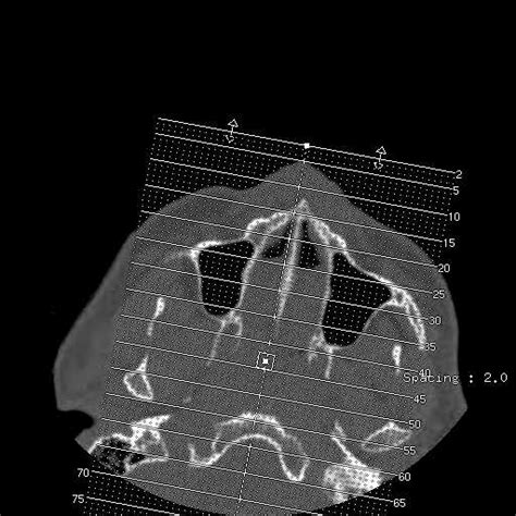 Facebook Fractures