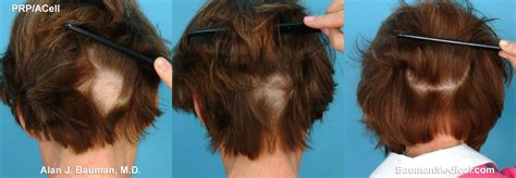 Female Alopecia Areata Patient Treated With Prp For Hair Regrowth