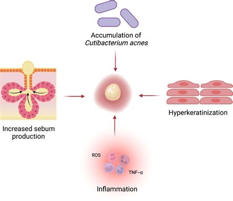 Acne Pathogenesis Interplay Of Increased Sebum Production