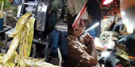 Telapak Tangan Budak 10 Tahun Hancur Akibat Tersepit Di Mesin Tebu