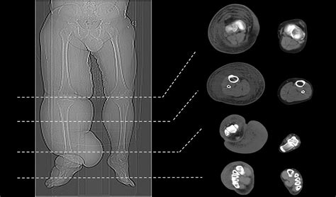 Effectiveness Of Vascularized Lymph Node Transfer For Extrem Plastic And Reconstructive