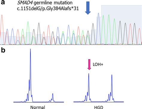 A Case 3 Underwent Genetic Testing Prior To Resection Which Revealed