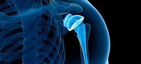 Is Shoulder Replacement Surgery Worth It A Guide Dr Paul J Ghattas