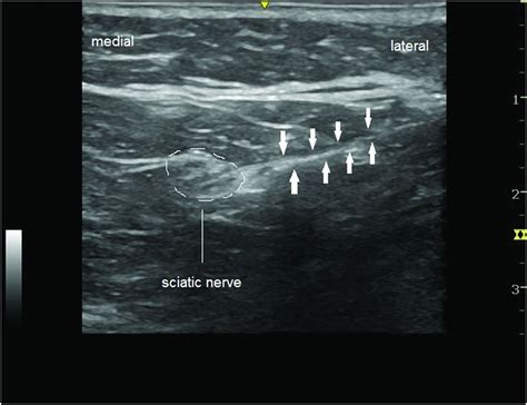 Ultrasound Guided Sciatic Nerve Block Anesthesia Key