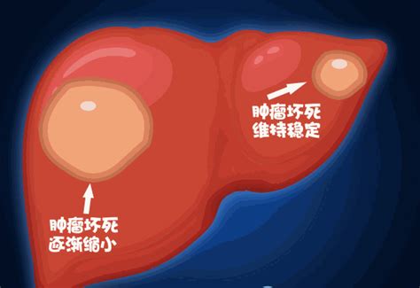 解析肝癌介入治疗 看这一篇就够了 微医挂号网