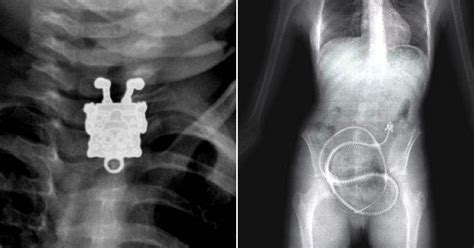 X Rays