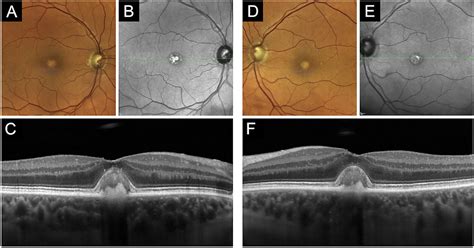 Vitelliform Maculopathy Diverse Etiologies Originating From One Common