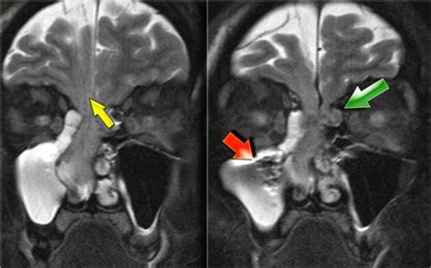 Sinus Images Mri Locations