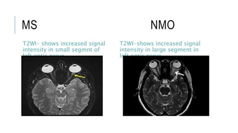 Optic Disc Swelling Pptx Eye And Vision Conditions Diseases And