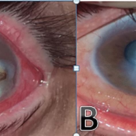 Fungal Keratitis Caused By Aspergillus Flavus With Hypopyon Download