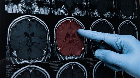 Los Accidentes Cerebrovasculares Provocarán Casi 10 Millones De Muertes