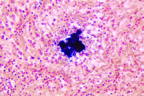 Granulation Tissue Containing Pathogenic Gr Microflora Dark Blue