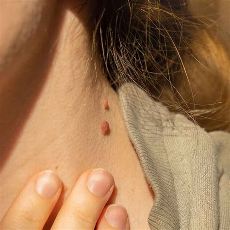 Understanding Skin Tags Causes And Removal Methods