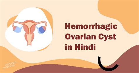Hemorrhagic Ovarian Cyst In Hindi सिस्ट होने के कारण और लक्षण