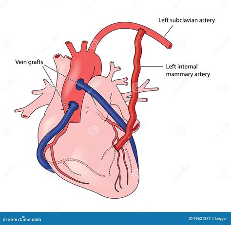 Coronary Artery Disease Info Graphic Heart Awareness Concept Vector