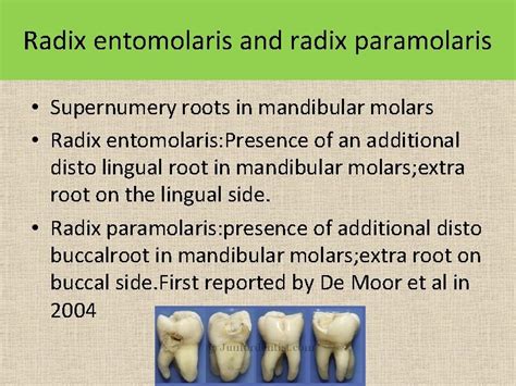 Access Cavity Preparation Contents Definition What Is An
