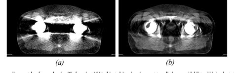 Figure 1 From The Impact Of A Metal Artefact Reduction Algorithm On Treatment Planning For