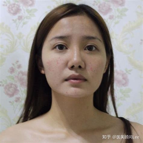 成功解决满脸闭口粉刺和痘痘，谈谈这2年我经历了什么 知乎