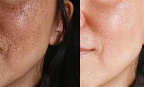 Exosome Treatment For Skin Rejuvenation Monaz Clinic London