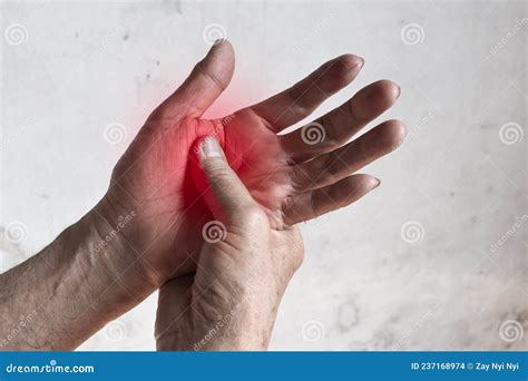 Painful Palm Of Asian Man Concept Of Compartment Syndrome Cellulitis