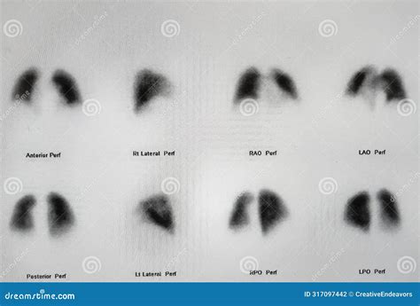 Lung Ventilation Perfusion Imaging Normal VQ Scan Stock Photo Image Of Embolism Nuclear