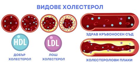 Висок холестерол Симптоми Причини Лечение Превенция