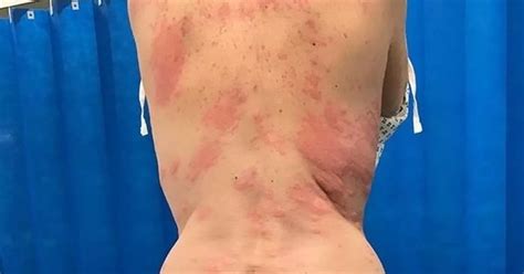 Mum Covered In Horrific Burning Rash After Vaping For The First Time