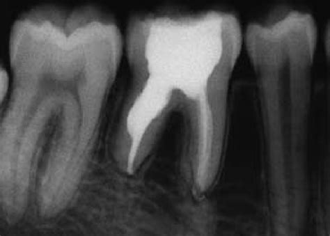Seven Month Recall Radiograph Shows Amalgam Restoration In Place And