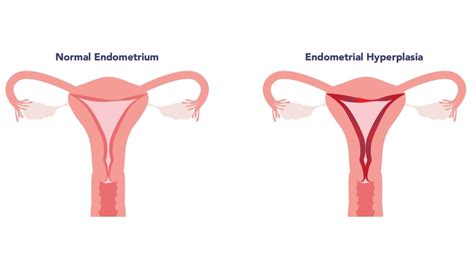 Endometrial Hyperplasia Information Evaluation And Treatment