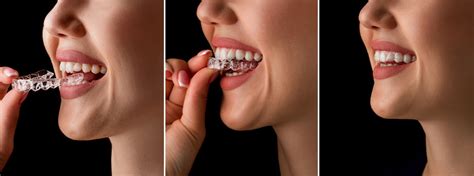 Things You Should Not Do During Aligners Treatment Here Are Tips To Care For Aligners