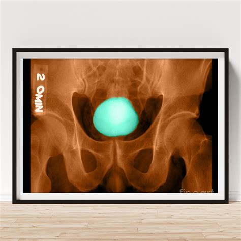 Normal Xray Of Urinary Bladder 2 Poster By Medical Body Scans