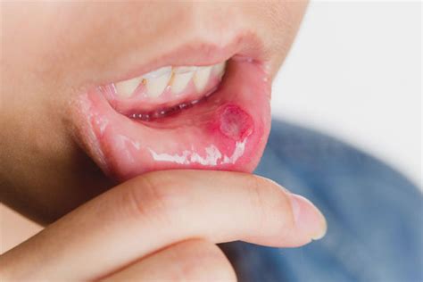 How To Get Rid Of Stomatitis At Home
