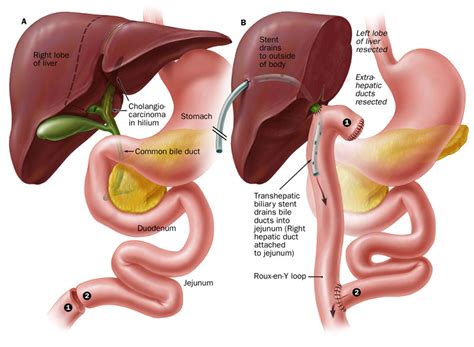 Bowel On Emaze